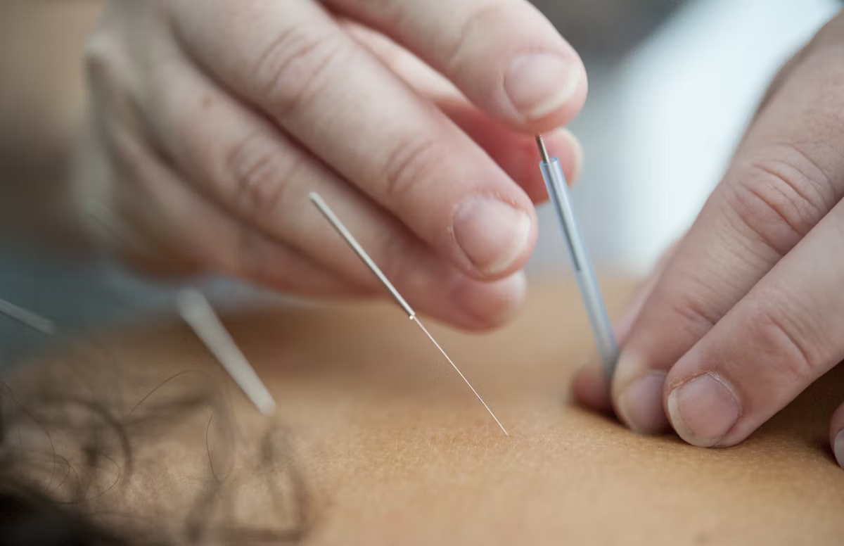 Traditional Acupuncture treatment