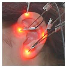 German Auricular Acupuncture treatment